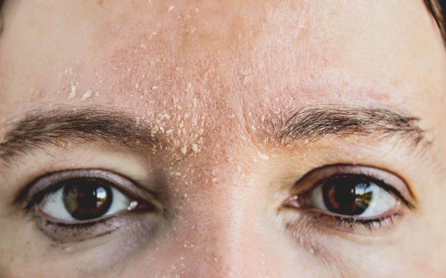 What is eczema/dry skin? - Beauté Pacifique - United Kingdom